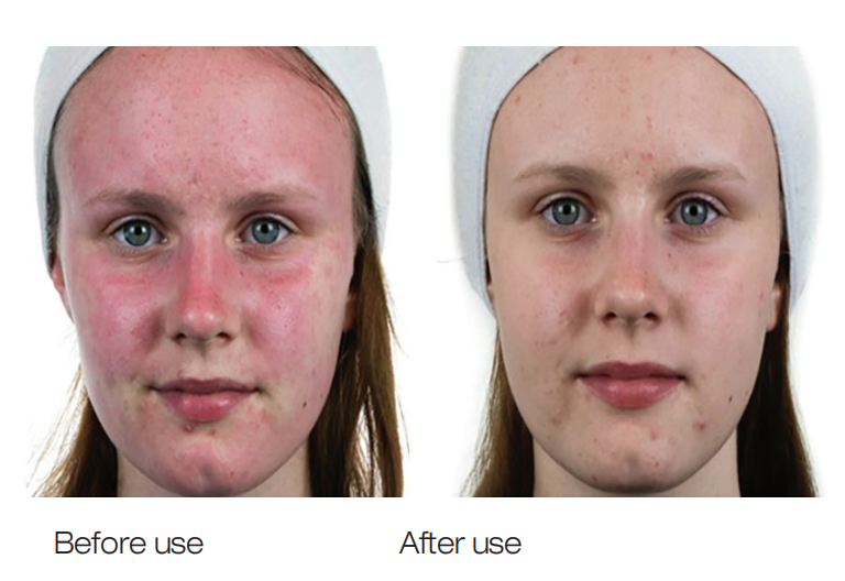 战痘刺客 胶态硫Sulfidal–真魅博客